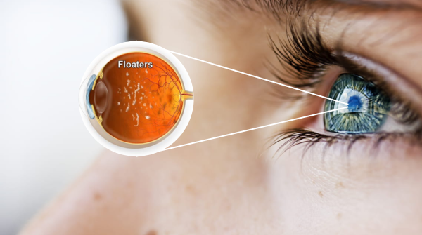 What causes floaters to form? – Mission Creek Optometry